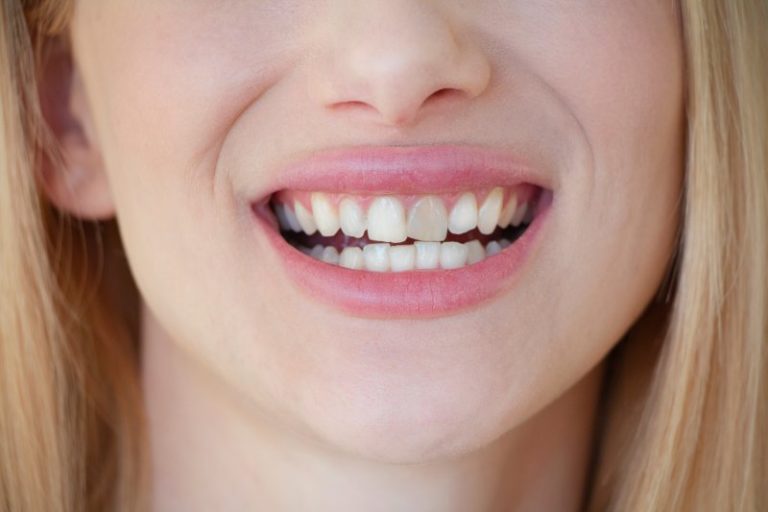 What Causes Gray Teeth And How To Fix It Aurora CO | Dr. Mauck